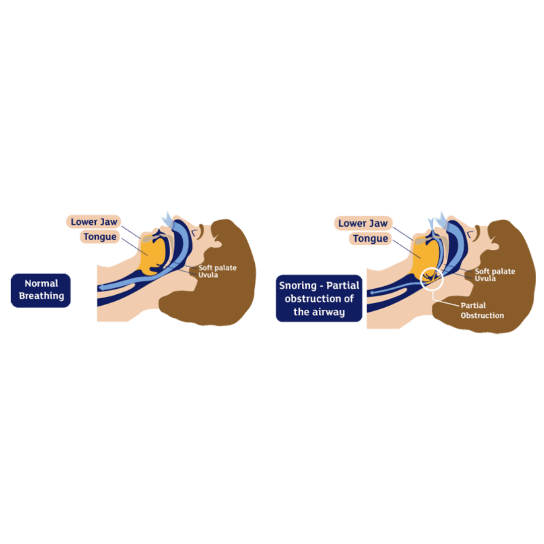 Snoring Caused By Congestion - Snoring Relief Solutions – Sleep Doctor